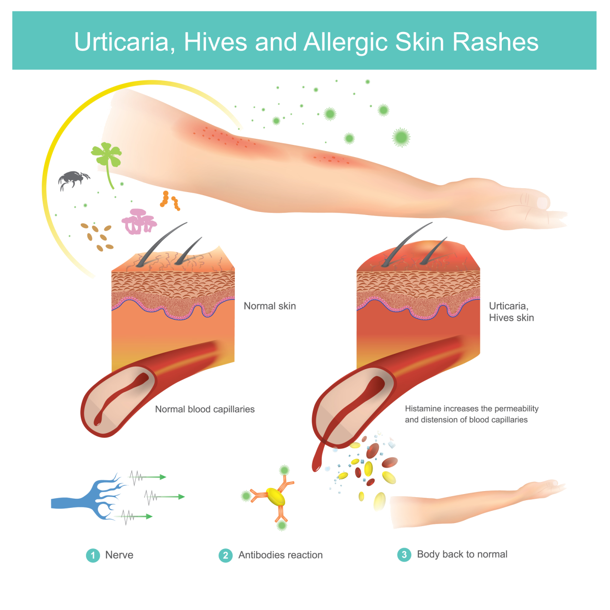 Dilgėlinė - Antalgija