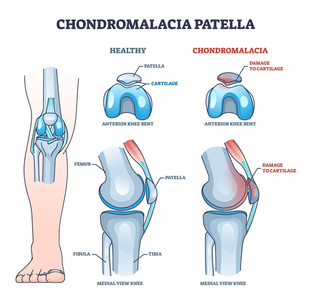 Girnel s Chondromaliacija Antalgija